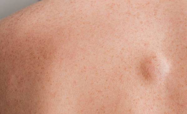 Qué es el sarcoma: síntomas, tratamientos y todo lo que hay que saber ...
