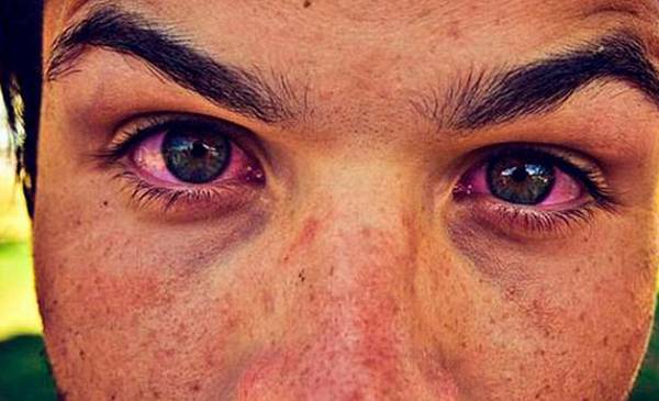 Ojos rojos: por qué se ponen así, causas y tratamiento | El Destape