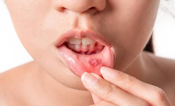 Por qué salen llagas en la boca | El Destape