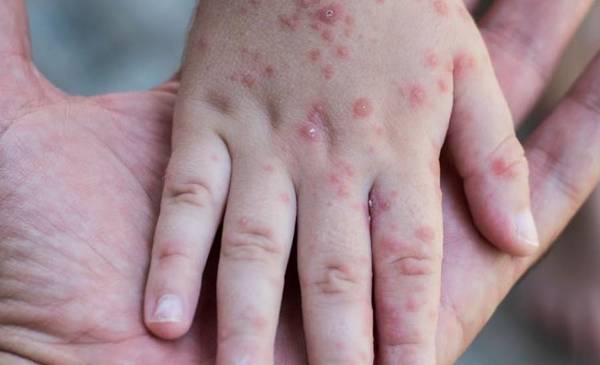 Enfermedad de manos, pies y boca: qué es, tratamiento y síntomas | El ...